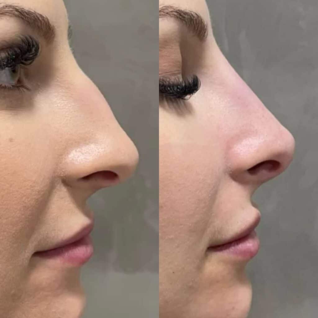 Classic Lips: Lábios valorizados com preenchimento harmônico e natural ...