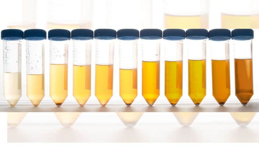 Sua urina pode revelar mais do que você imagina; entenda - Aqui Notícias